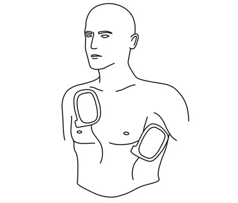 Transcutaneous Pacing Osce Guide External Pacing Geeky Medics