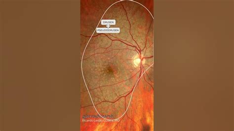 Drusen And Reticular Pseudodrusen Subretinal Drusenoid Deposits Youtube