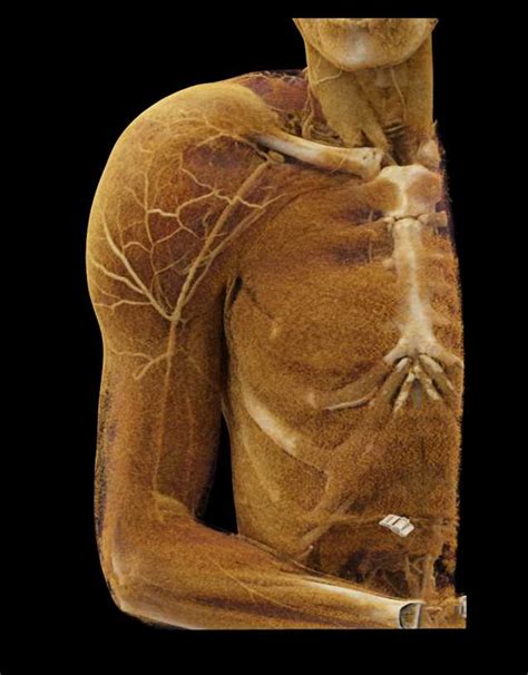 Sarcoma Right Shoulder With Cinematic Rendering Ctisus Cutting Edge Information On Body