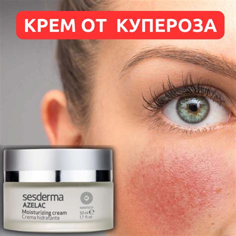 КУПЕРОЗ – Причины - Симптомы - Профилактика - Лечение