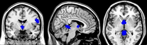 Unlocking The Brain In Functional Neurological Disorders What Research Reveals About Structural