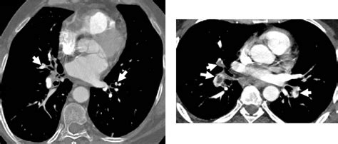 Figure 1 From Computer Aided Detection Of Pulmonary Embolism In