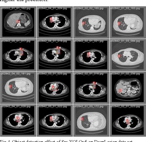 Table I From Research On Medical Image Object Detection Based On Swin Transformer And YOLOv