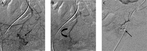 Successful Microcoil Embolization In A 72 Year Old Woman With