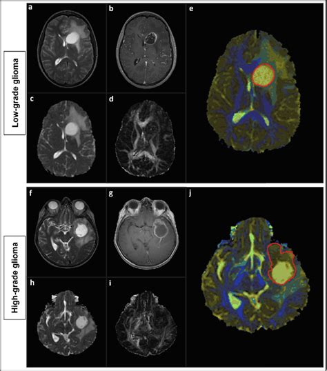 Whole Brain Segmented Maps Of A Lgg E And A Hgg J Case Resulting Download Scientific