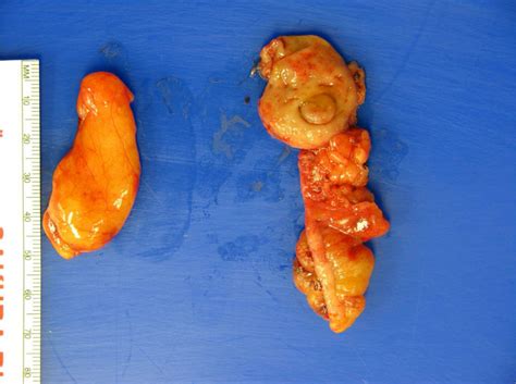 Pathology Outlines Serrated Polyp