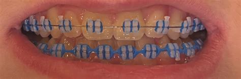 Lightforce Braces Faster Custom Treatment — Shine Ortho Studio