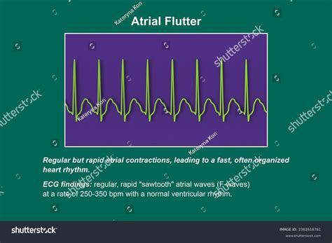 Ecg Atrial Flutter Abnormal Heart Rhythm Stock Illustration 2382618761