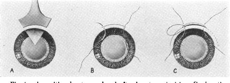 Figure 1 From A Simple Appositional Suture In Operations For Cataract