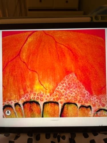 Retinal Degenerations Flashcards Quizlet