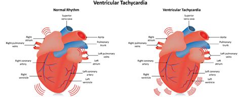 6 Faqs Guide Your Tachycardia Icd 10 Cm Coding Choices Quiz
