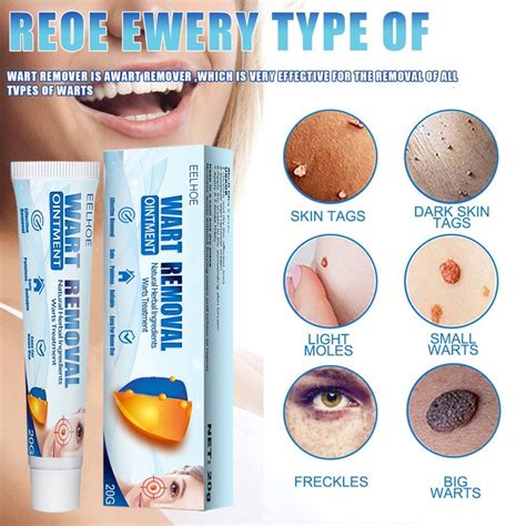 Jual Eelhoe Wart Removal Treatment Cream Salep Obat Penghilang Tahi Lalat Dan Kutil 20gr Skin