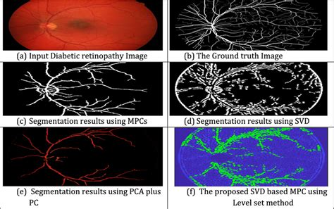 Example Image 4 Simulation Results On Diabetic Retinopathy Images