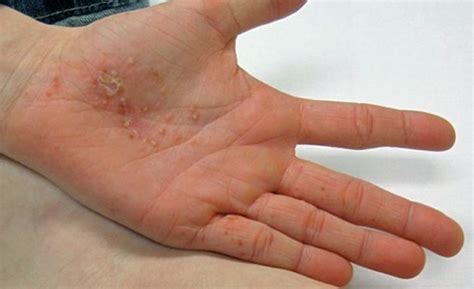 Dyshidrotic Eczema Health And Medical Articles Hellomrdoctor