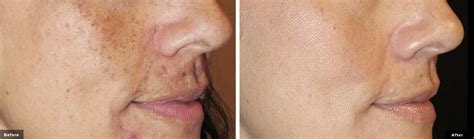 Pico Enlighten San Jose CA Jenesis Lipoplasty