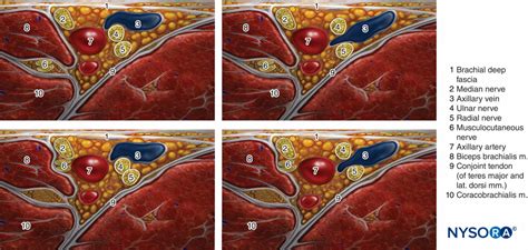 Ultrasound Guided Axillary Brachial Plexus Block Nysora