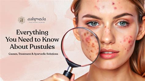 Everything You Need To Know About Pustules Causes Treatment