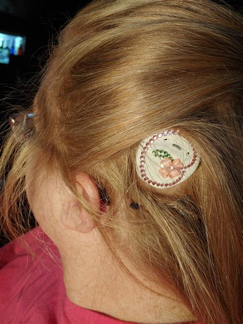 Lisas Cochlear Implant Helps As A Solution To Single Sided Deafness