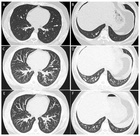 Osteosarcoma Metastasis To The Thorax A Pictorial Review Of Chest Computed Tomography Findings