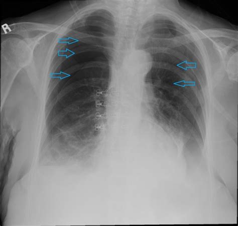 Radiation And Bilateral Spontaneous Pneumothoraces Pmc