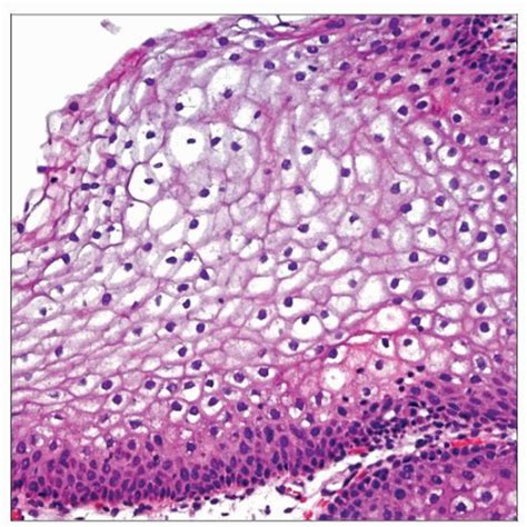 Squamous Proliferations Other Than Carcinoma Basicmedical Key