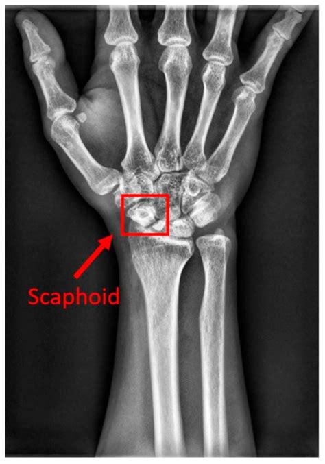 The Detection And Classification Of Scaphoid Fractures In Radiograph By