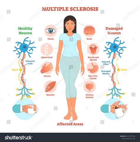 Multiple Sclerosis Anatomical Vector Illustration Diagram Stock Vector