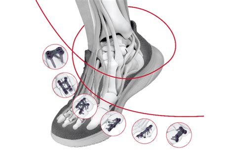 J J S DePuy Synthes Launches New Plating System
