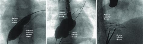 Balloon Occlusion Of First Defect Allows Cannulation Of The Second