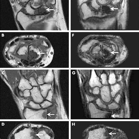 Synovitis In Ra Mcp Joints Visualised By High Field And Low Field Mri Download Scientific