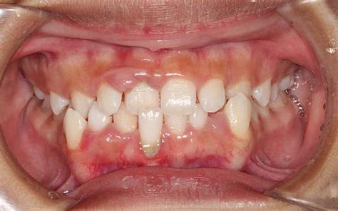 Calculus Object Detection Dataset And Pre Trained Model By Ashvikha