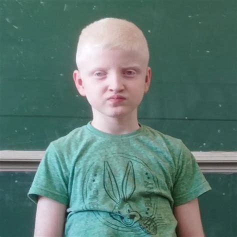 This is Ali, a beautiful 10-year-old albino boy who recently lost both of his parents. Now an ...