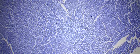 Myocardial Biopsy
