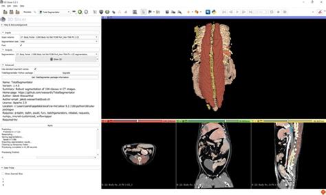 New Extension Fully Automatic Whole Body Ct Segmentation In 2 Minutes Using Totalsegmentator