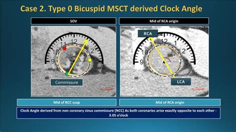 Essentials Of Lifetime Management In Patient Undergoing Tavi Using Novel Balloon Expandable