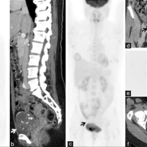 Sagittal Positron Emission Tomography A And Computed Tomography B Download Scientific