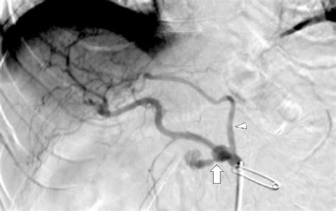 Figure 1 From Coil Embolization Of A Celiac Artery Pseudoaneurysm Under Balloon Assisted Flow