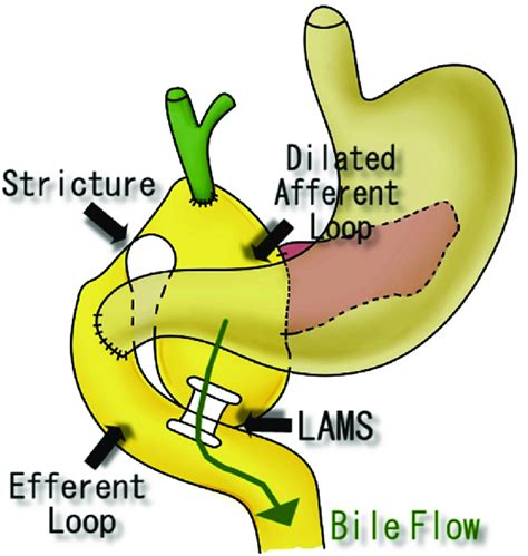 Schematic Illustration Of A Pylorus Preserving Duodenopancreatectomy Download Scientific