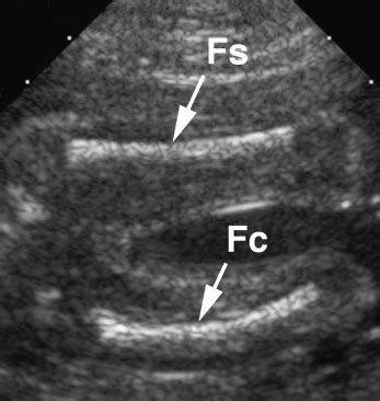 Ultrasound Evaluation Of Normal Fetal Anatomy Radiology Key