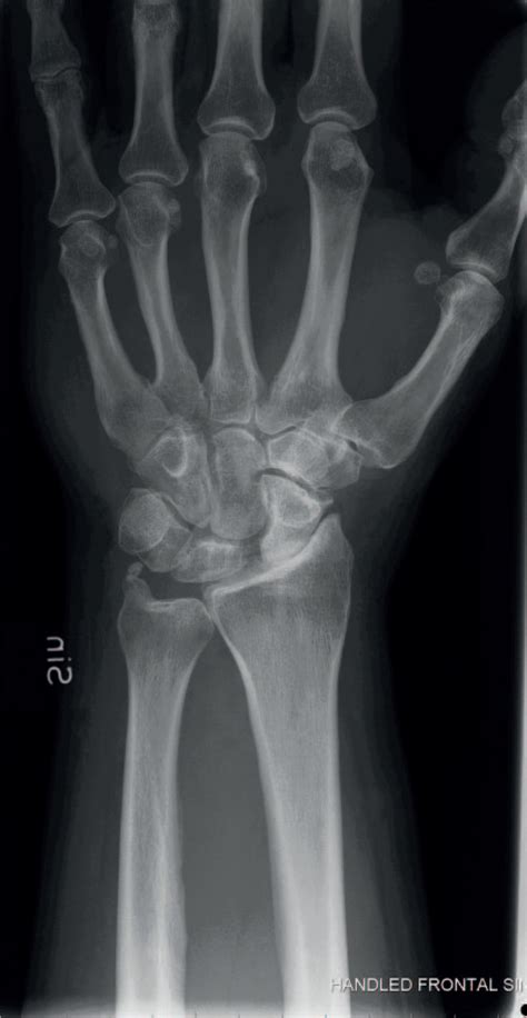 Scapholunate Dislocation