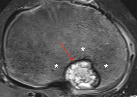 Chondroblastoma Of The Proximal Tibia Eurorad