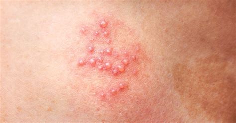 Shingles And Encephalitis Symptoms Causes And Treatment