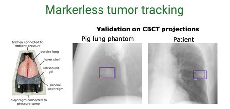 Markerless Tumor Tracking Lmu Art Lab