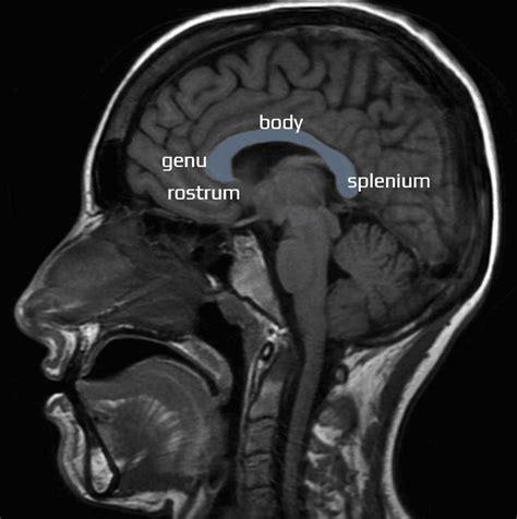 Corpus Callosum Anatomy