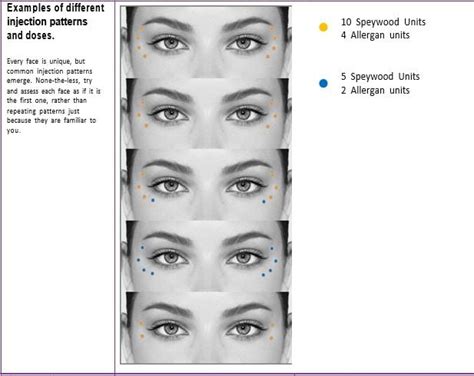 Top 3 Botox Injection Patterns Markup Skinviva Training
