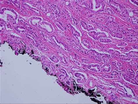 Tumor Reaches The Inked Surgical Margin Hande X200 Figure 2 Tumor Download Scientific