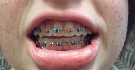 18+ Info Terkini Braces 4 Month