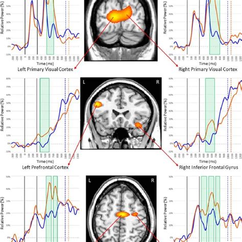 Fig Ure 1 Posner Cueing Task A Fixation Cross Was First Presented For