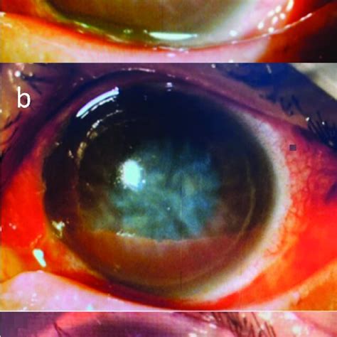 A A Case With Anterior Segment Ischemia After Xt Combined With So And