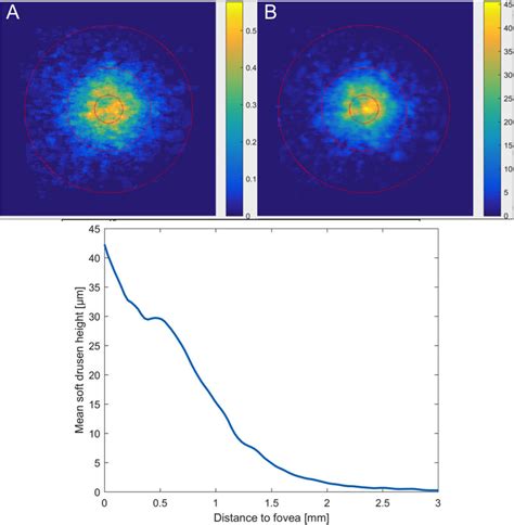 Soft Drusen Metrics A Spatial Distribution Of Soft Drusen Across The Download Scientific